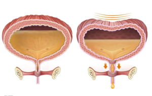 Neurogenic Bladder Treatment in Children – Hyderabad